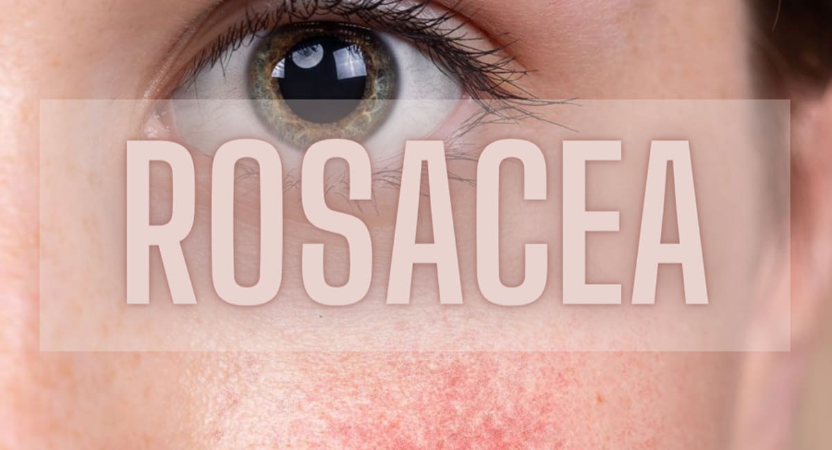 Rosy Revelations: How we treat Rosacea - Greenwich Point Dermatology